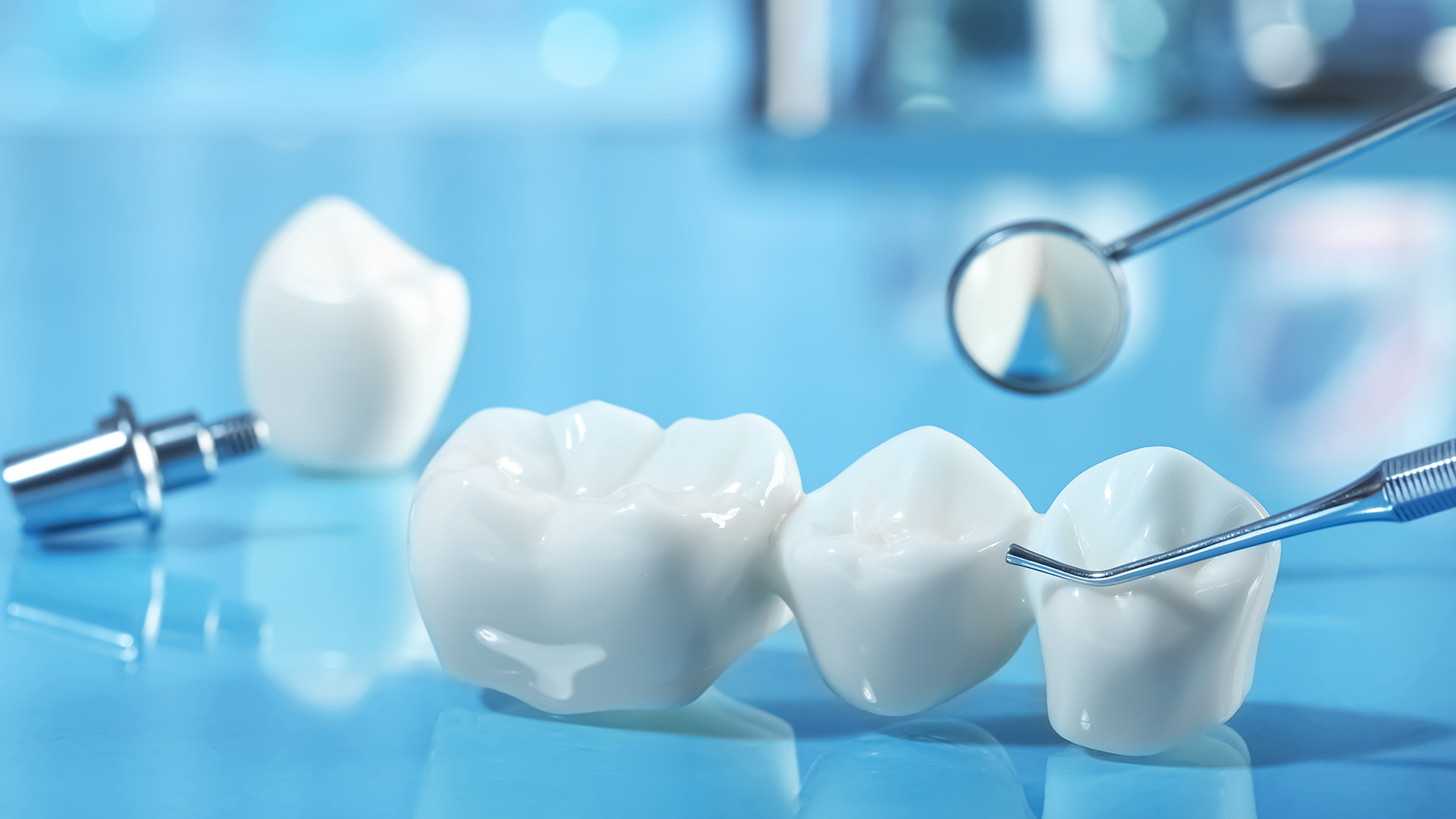 Single Tooth Implant vs Dental Bridge: What’s Best for You?